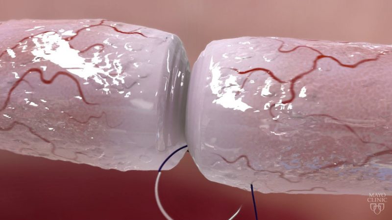 Vasectomy Reversal | Medithics Blog