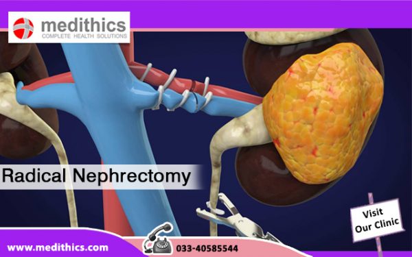 Radical Nephrectomy- A brief discussion about treatment and procedure
